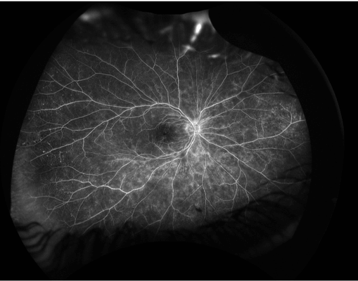 The Retina Clinic London | Birdshot Chorioretinopathy