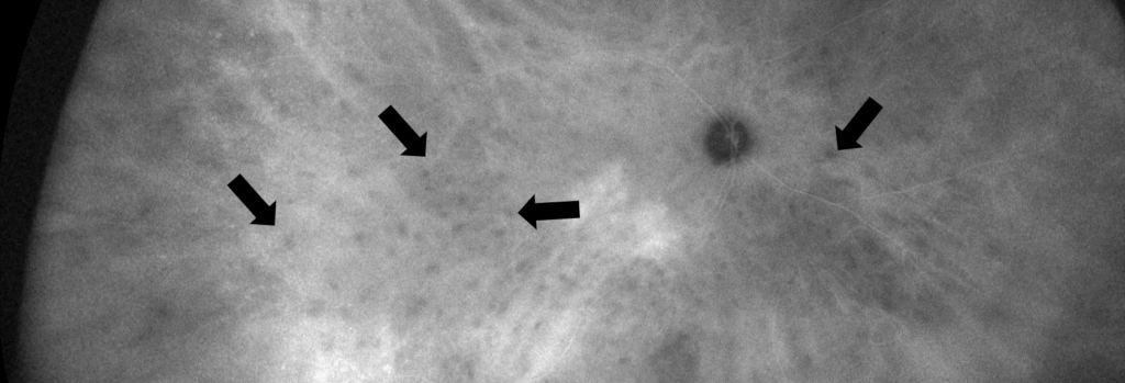 The Retina Clinic London | Birdshot Chorioretinopathy