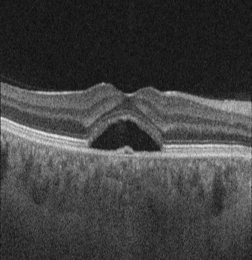 Fundus Fluorescein Angiography Central Serous Retinopathy