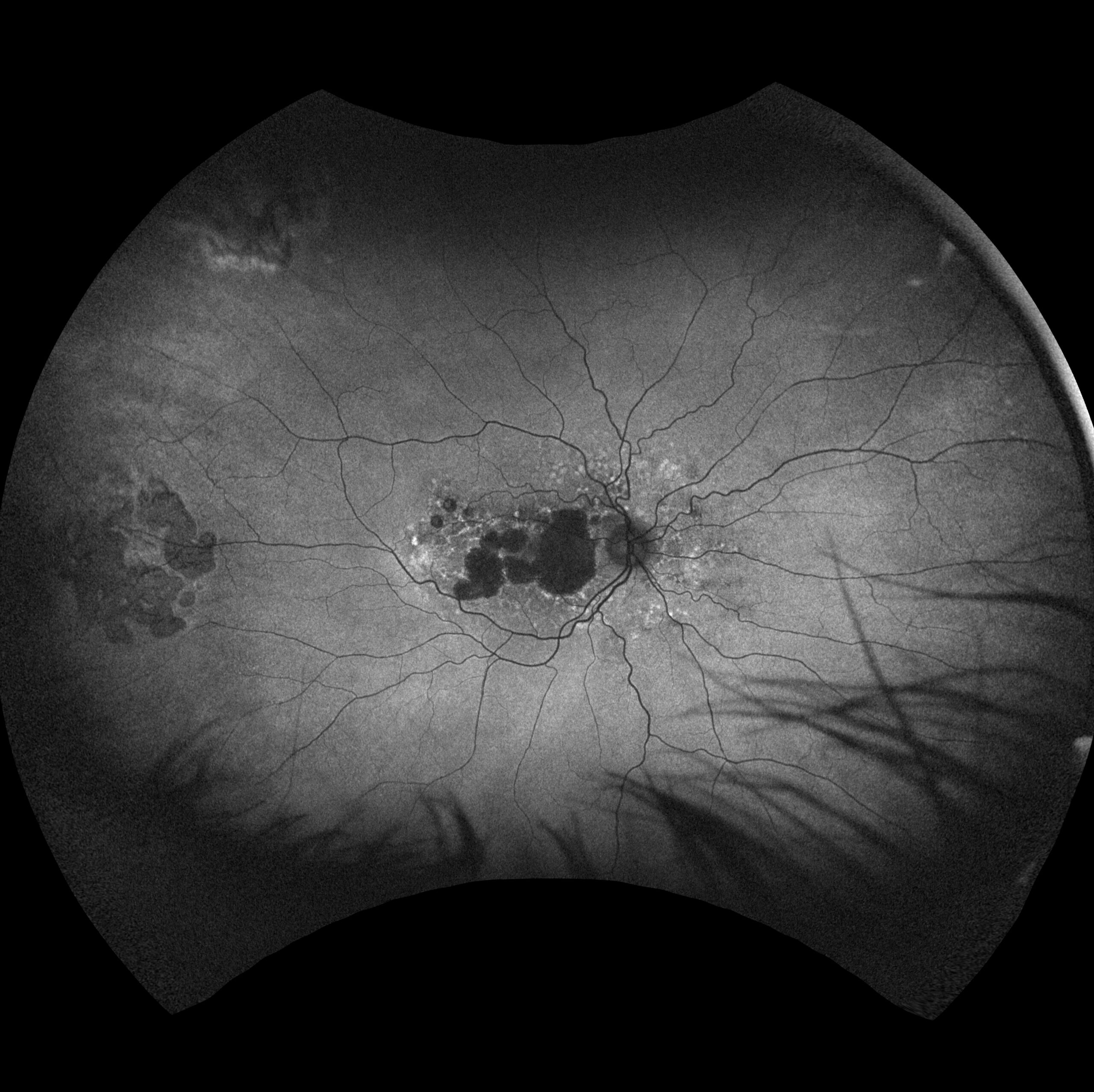 The Retina Clinic London | Age Related Macular Degeneration