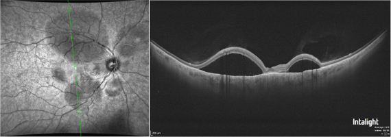 The Retina Clinic | Vogt-Koyanagi-Harada Syndrome