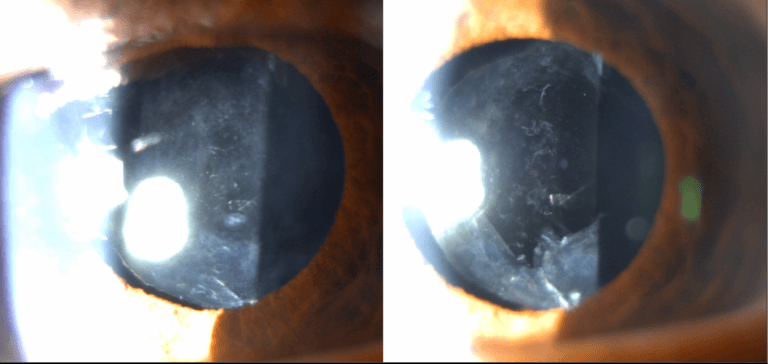 YAG Posterior Capsulotomy Laser at The Retina Clinic London